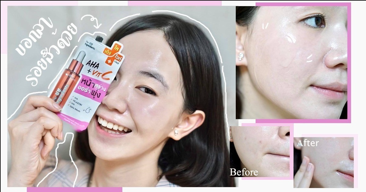 รีวิวพลีชีพ !! บอกลา รอยสิว ด้วยเซรั่ม VitC คูณ3 | Scale Gail | บทความ ...